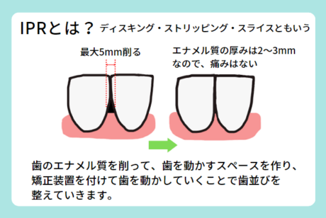 裏側矯正でもIPRをしますか？｜大阪矯正歯科グループコラム